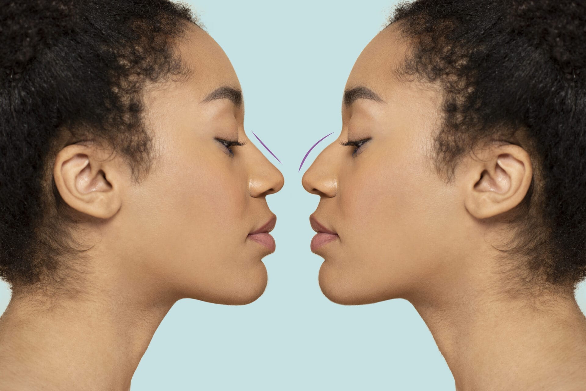 Nasal Septum Perforation Surgery FAQs | Rhinoplasty LDN